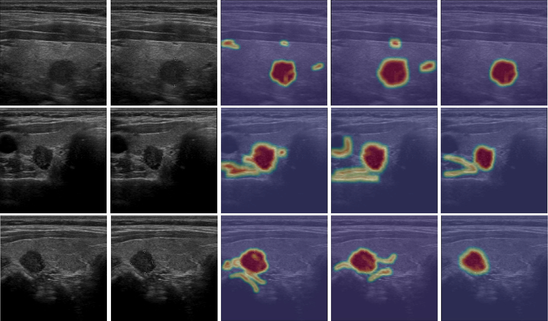 Multimodal Feature Fusion and Knowledge-Driven Learning via Experts Consult for Thyroid Nodule ...